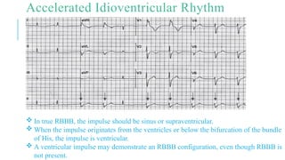 Intraventricular conduction block....... | PPTX