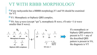 Intraventricular conduction block....... | PPTX