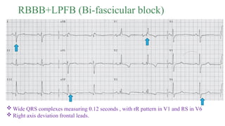 Intraventricular conduction block....... | PPTX