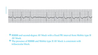 Intraventricular conduction block....... | PPTX