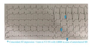 Intraventricular conduction block....... | PPTX