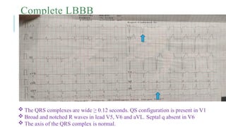Intraventricular conduction block....... | PPTX
