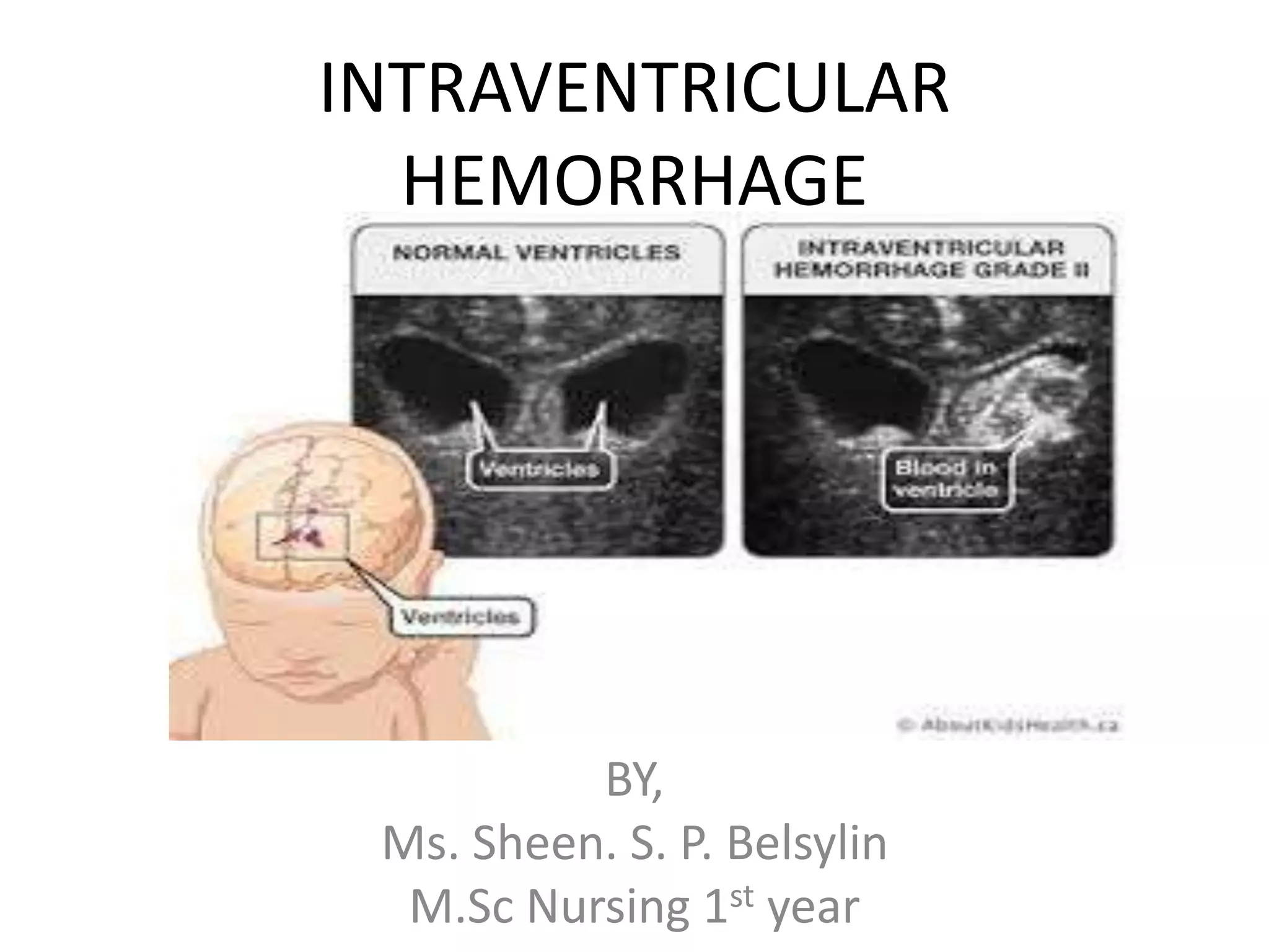 Intraventricular hemorrhage | PPTX