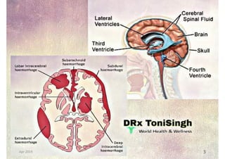 Intraventricular hemorrhage | PDF