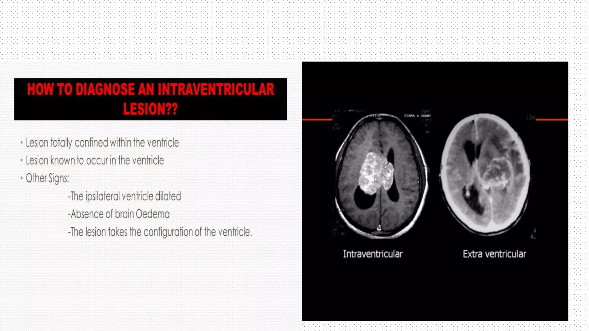 Intraventricular mass (Radiology) of a child {A CASE} | PPTX