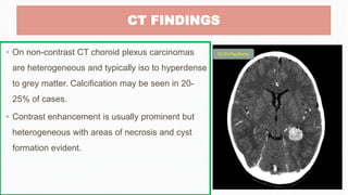 Intraventricular mass (Radiology) of a child {A CASE} | PPT