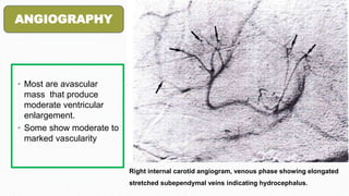 Intraventricular mass (Radiology) of a child {A CASE} | PPT
