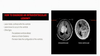 Intraventricular mass (Radiology) of a child {A CASE} | PPT