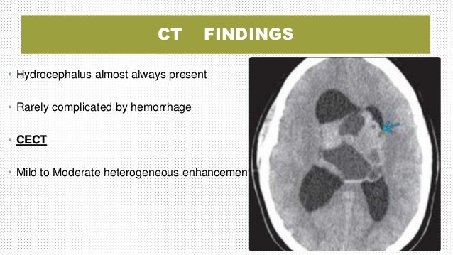 Intraventricular mass (Radiology) of a child {A CASE}
