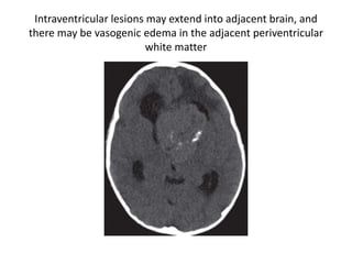 Intra ventricular neoplasms | PPTX