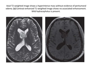 Intra ventricular neoplasms | PPTX