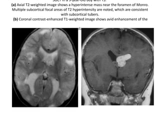 Intra ventricular neoplasms | PPTX