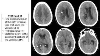 Intraventricular Rupture of Brain Abscess (IVROBA).pdf