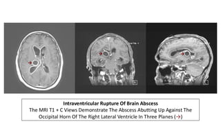 Intraventricular Rupture of Brain Abscess (IVROBA).pdf