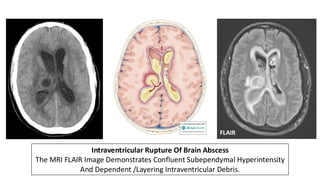 Intraventricular Rupture of Brain Abscess (IVROBA).pdf