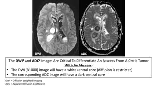 Intraventricular Rupture of Brain Abscess (IVROBA).pdf