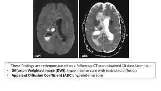 Intraventricular Rupture of Brain Abscess (IVROBA).pdf