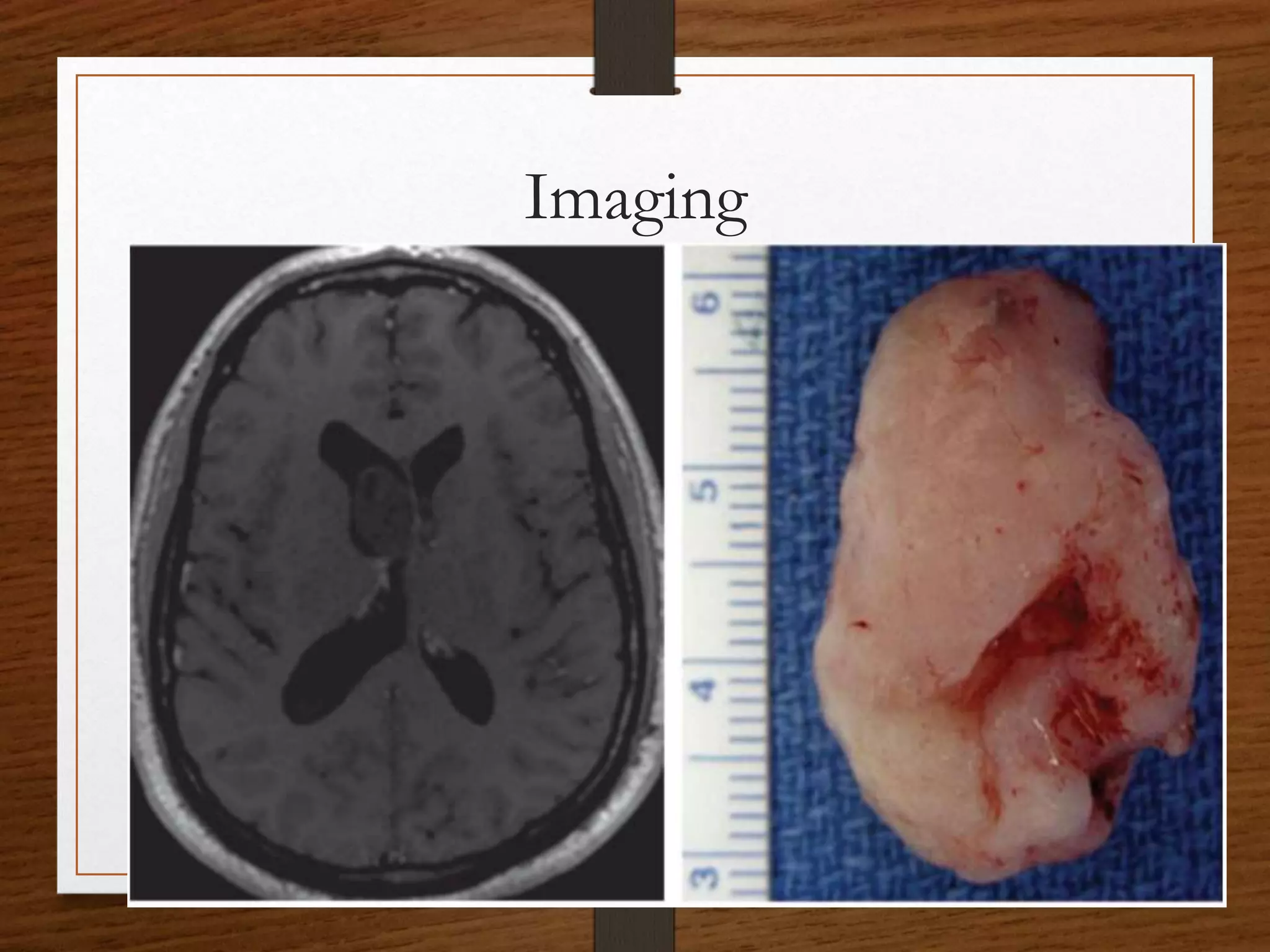 Intraventricular tumors | PPTX