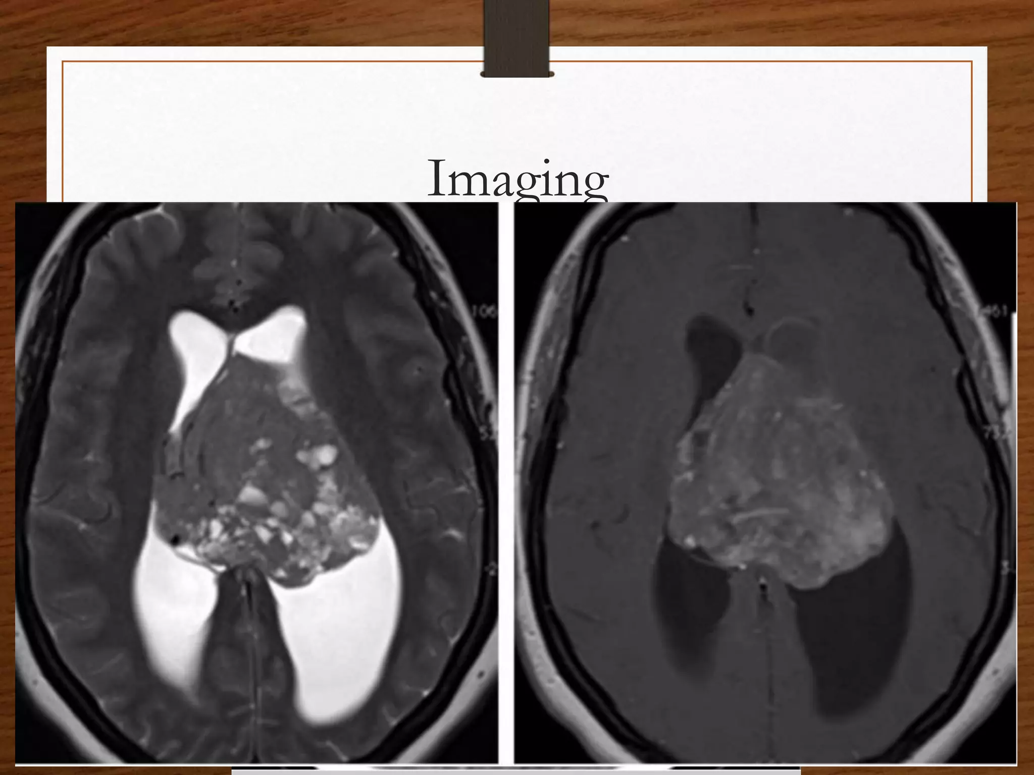 Intraventricular tumors | PPTX