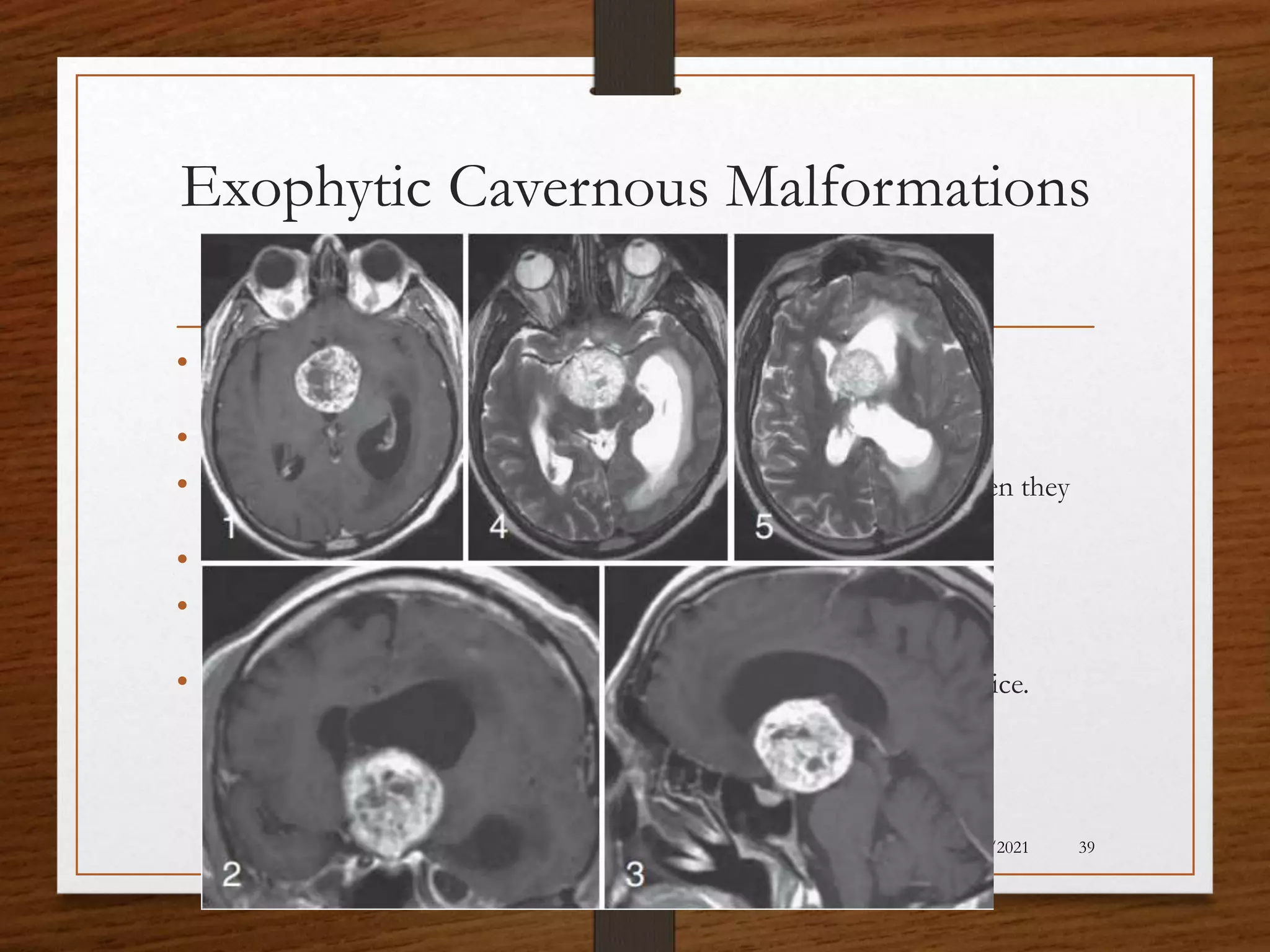 Intraventricular tumors | PPTX