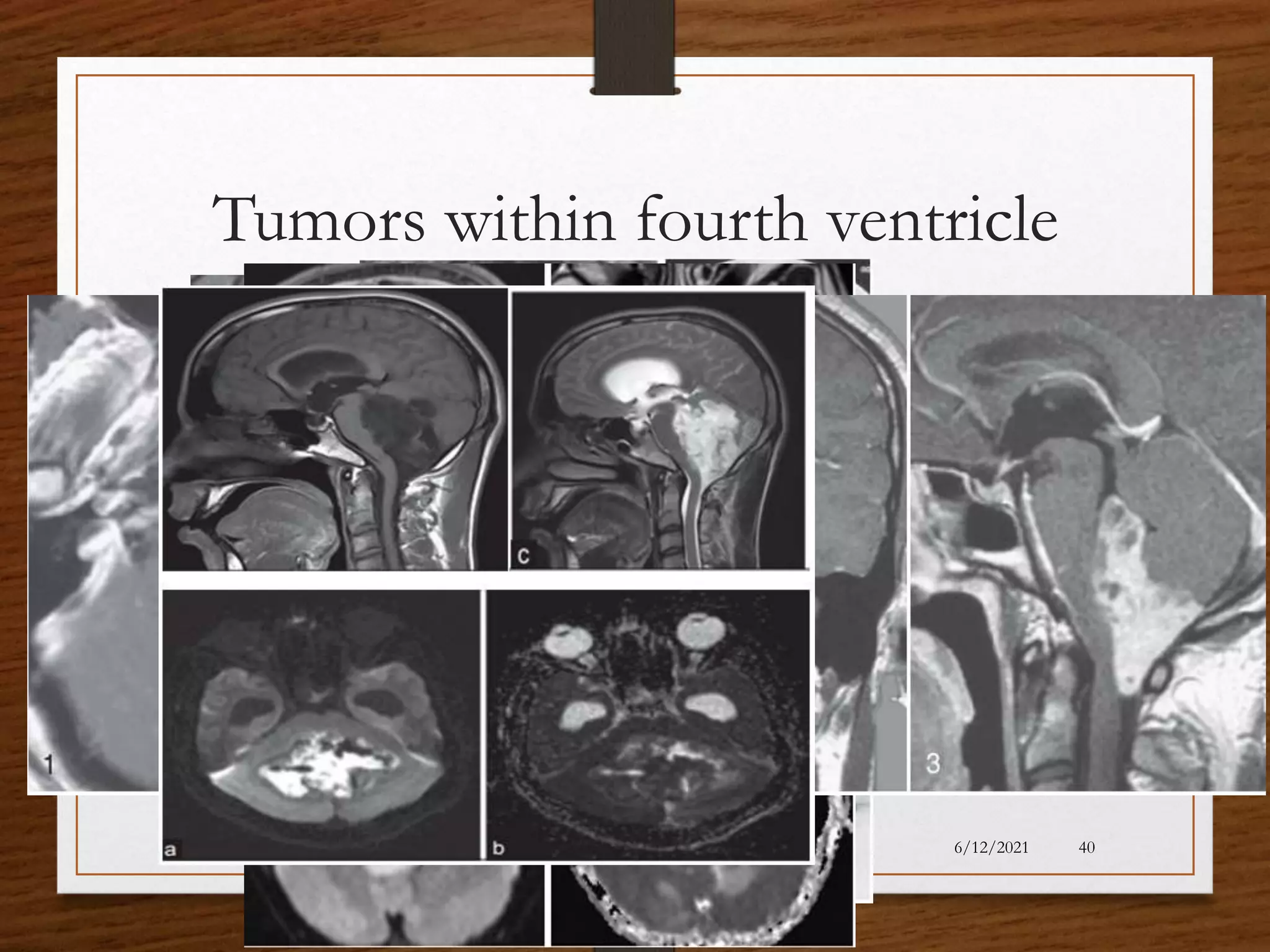 Intraventricular tumors | PPTX | Brain and Nervous System Disorders ...