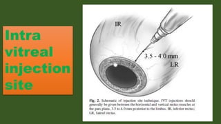 Intravitreal injection | PPTX