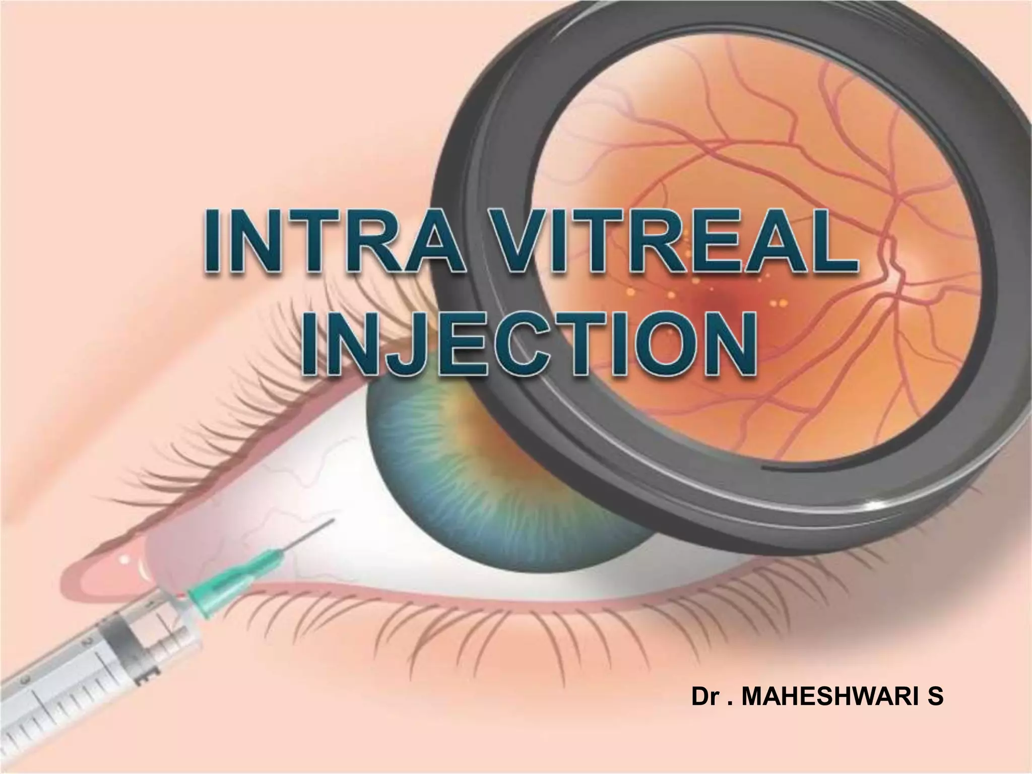 Intravitreal injection | PPTX