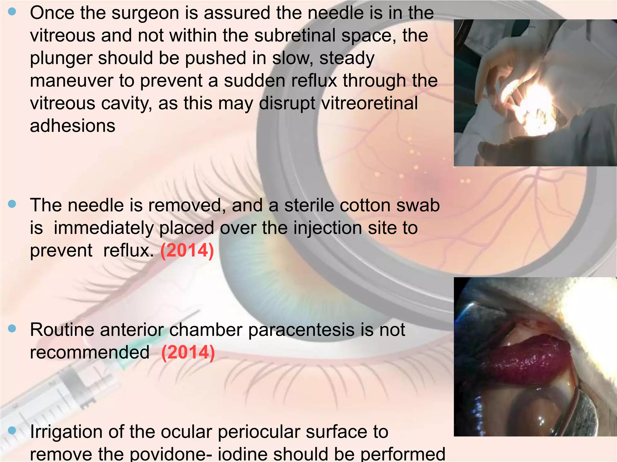 Intravitreal injection | PPTX