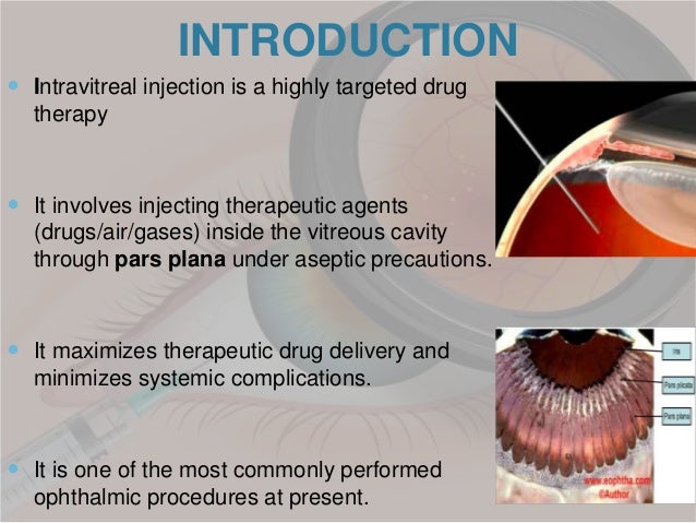 Intravitreal injection