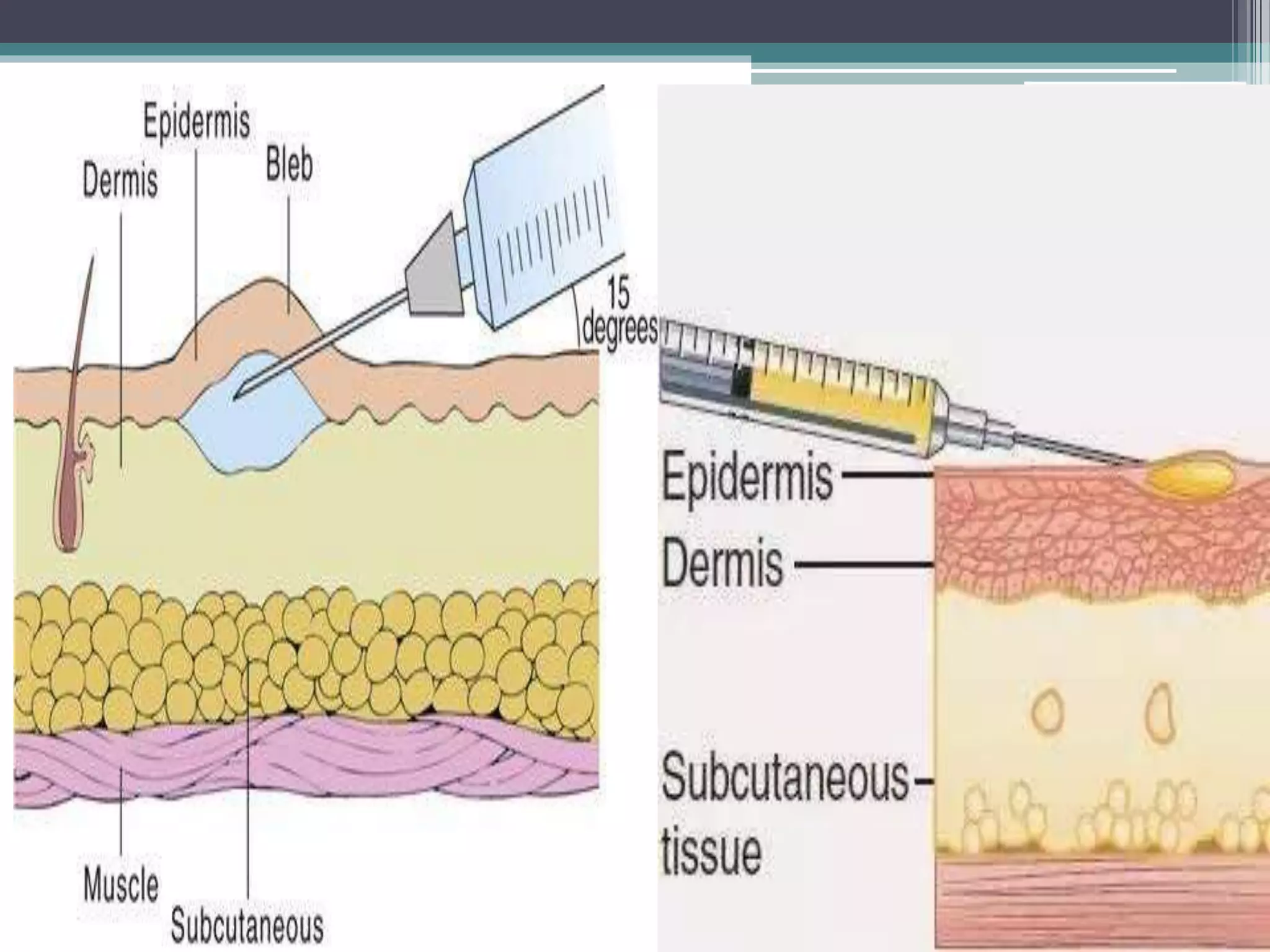 Intradermal | PPTX