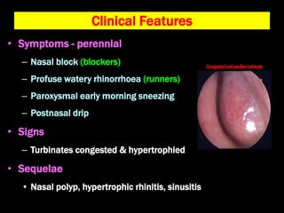 Intrinsic Rhinitis and Rhinitis Medicamentosa | PPT