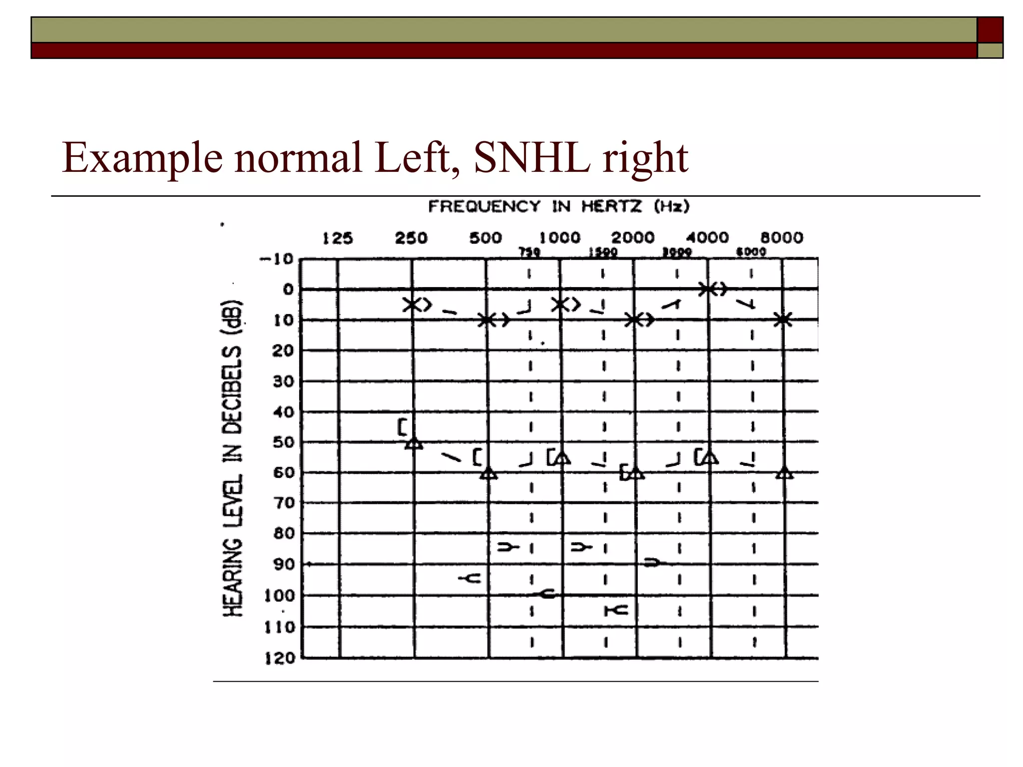 Introduction to Basic Audiology | PPT