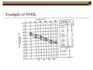 Introduction to Basic Audiology | PPT