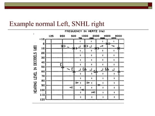 Introduction to Basic Audiology | PPT