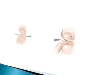 osteology of clavicle | PPTX