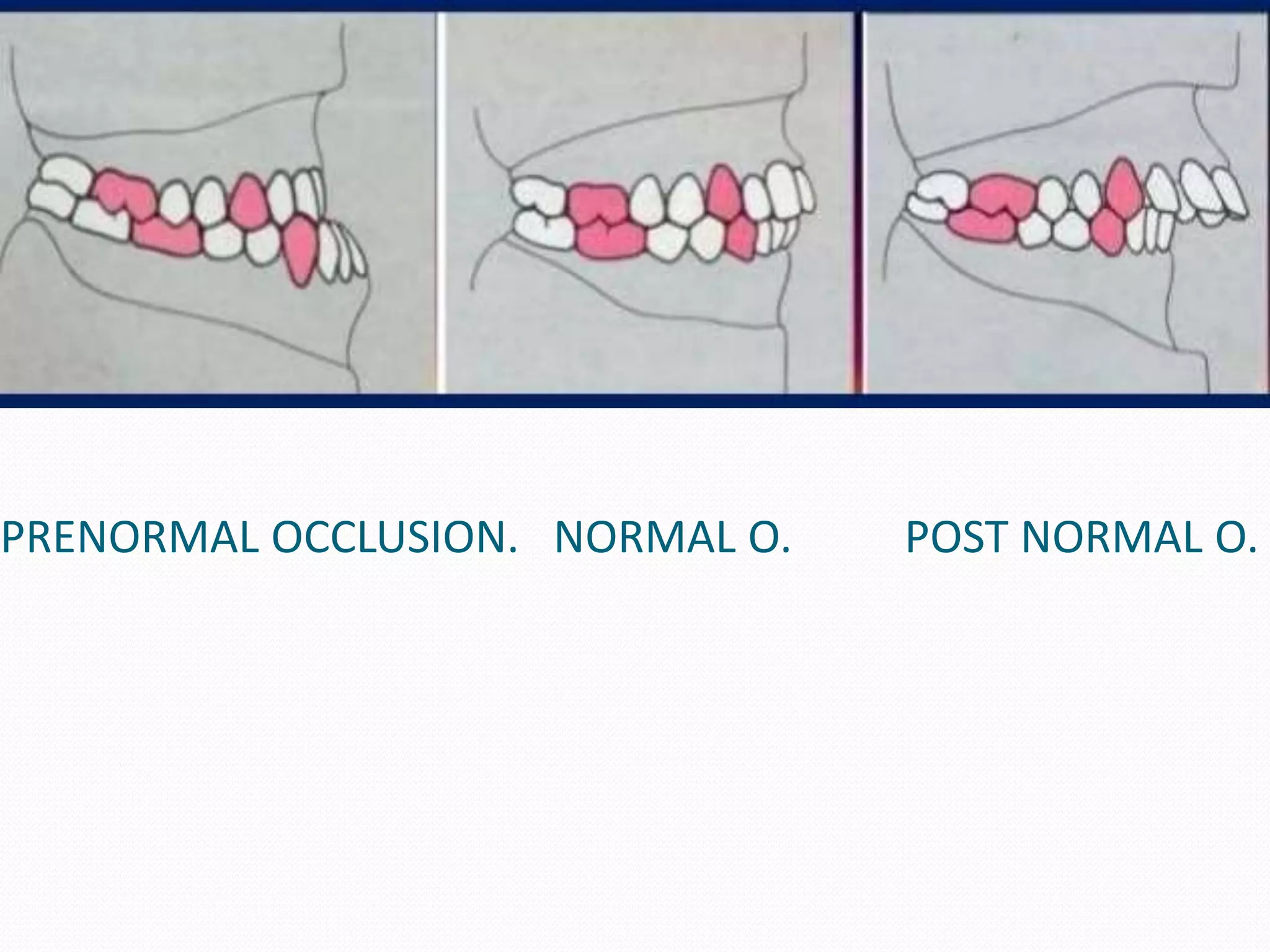 Introduction TO CLASSIFICATION OF MALOCLLUSION | PPT