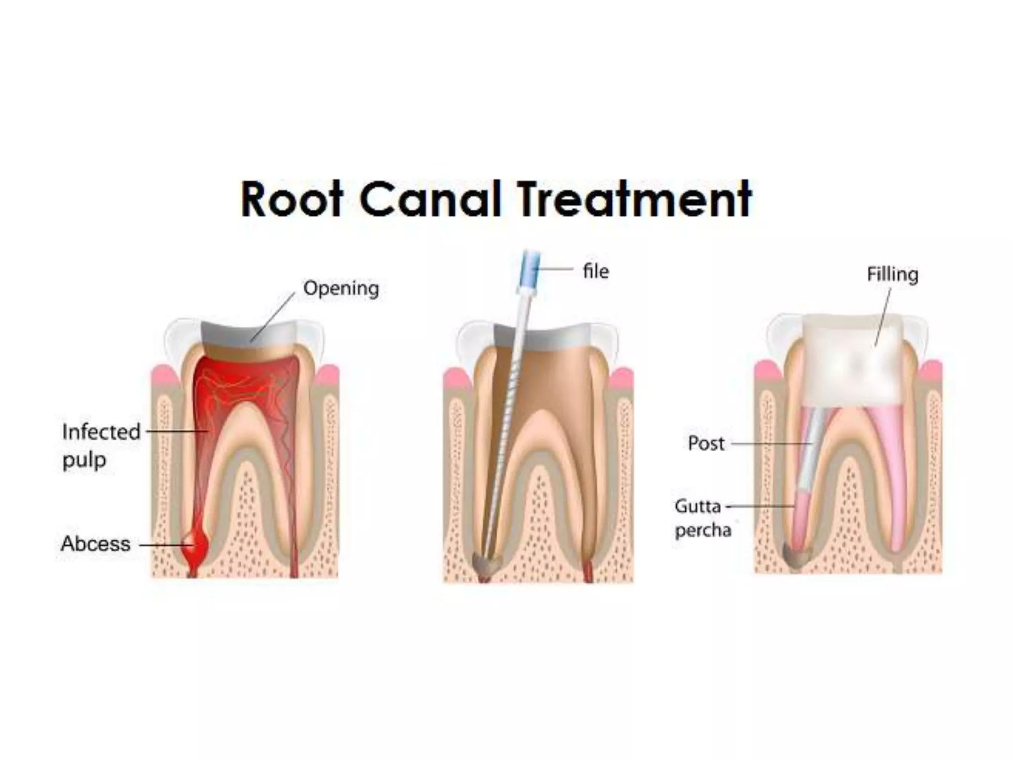 Introduction to Endodontics | PPTX