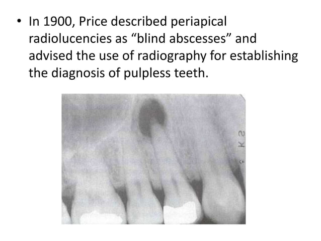 Introduction to Endodontics | PPTX | Dental Health | Diseases and Conditions