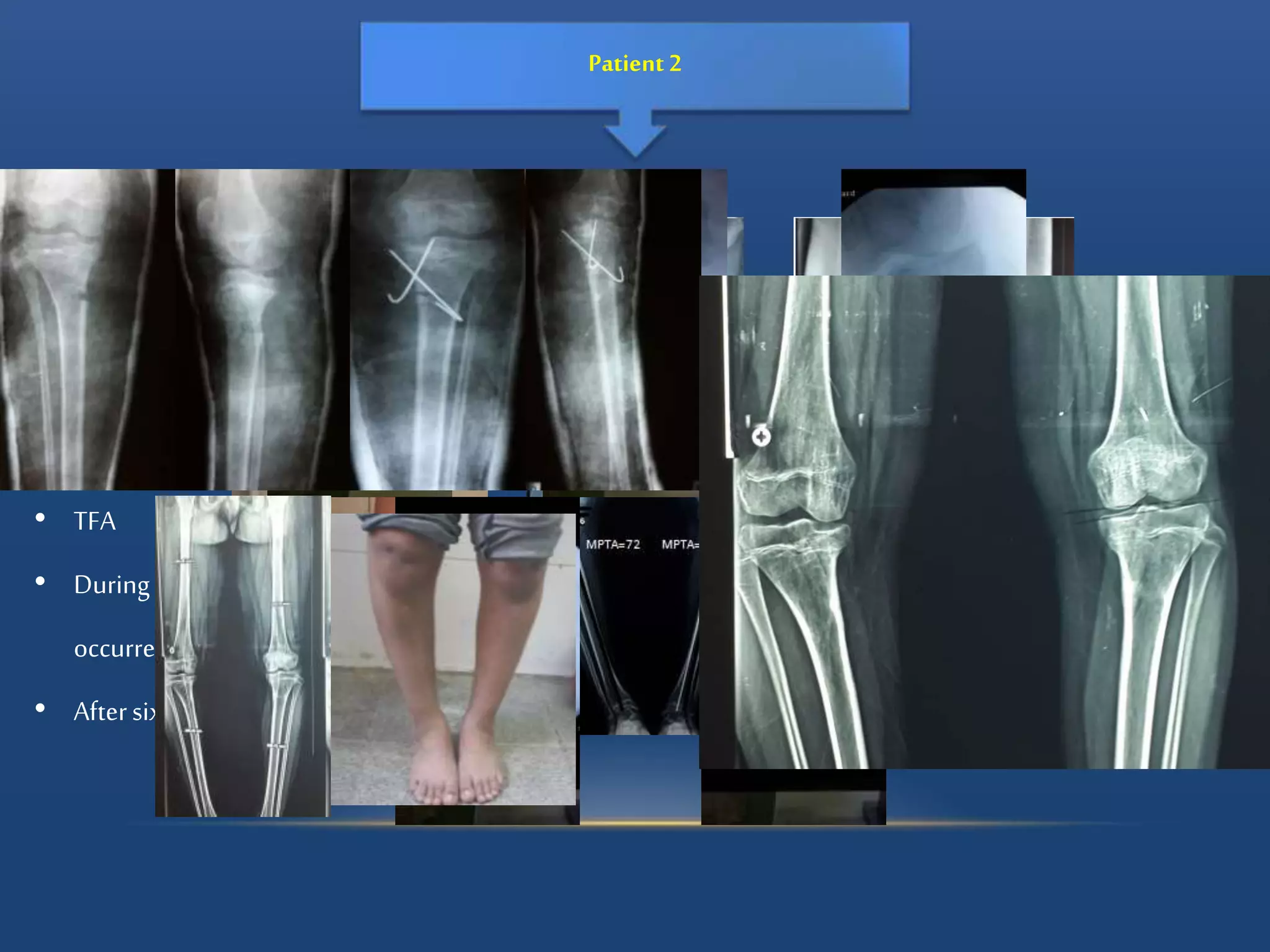 Percutaneous drilling tibial osteotomy for correction of genu varum in ...