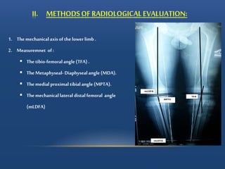 Percutaneous drilling tibial osteotomy for correction of genu varum in ...