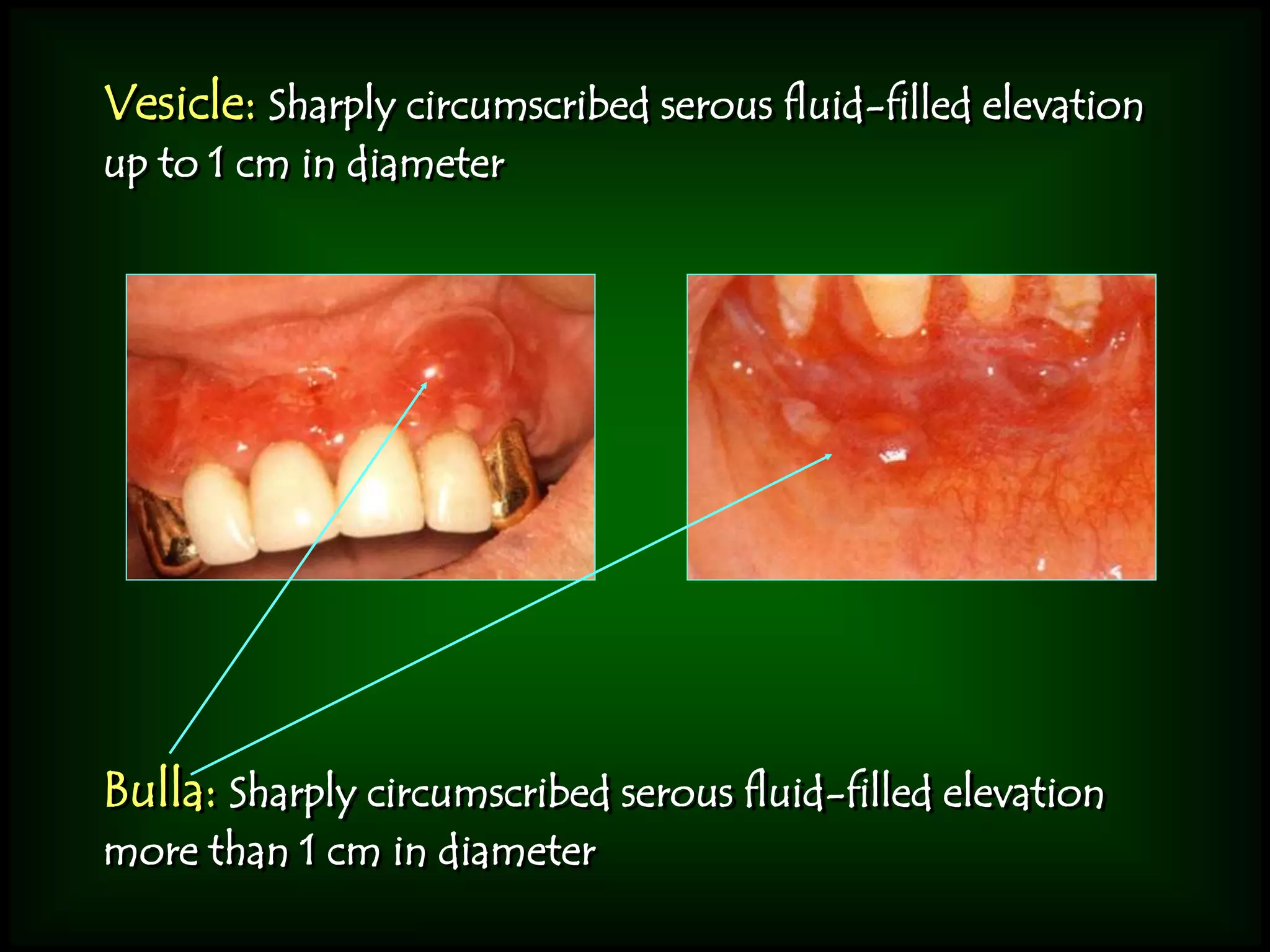 Introduction oral medicine-primary and secondary lesions | PPT