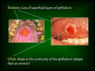 Introduction oral medicine-primary and secondary lesions | PPT