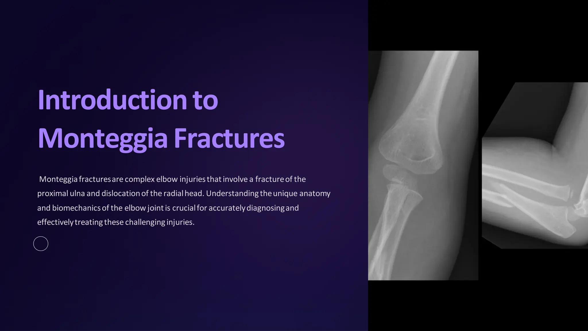 introduction to Monteggia Fractures------ | PPT