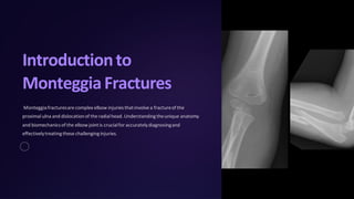 introduction to Monteggia Fractures------ | PDF