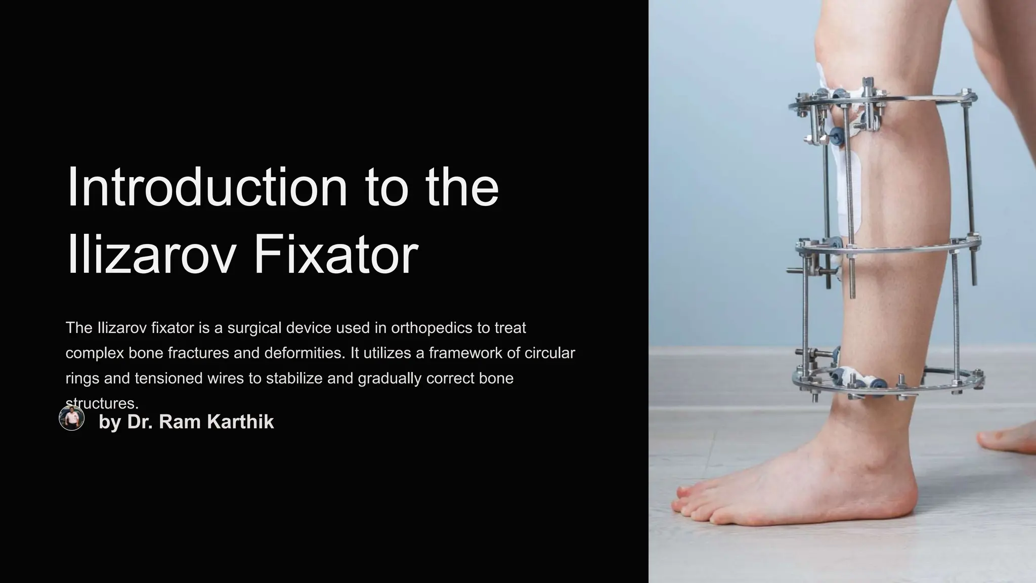 Introduction-to-the-Ilizarov-Fixator.pptx | Physical Therapy | Wellness