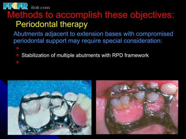 Introduction and basic components of rpd's copy | PPT | Dental Health ...