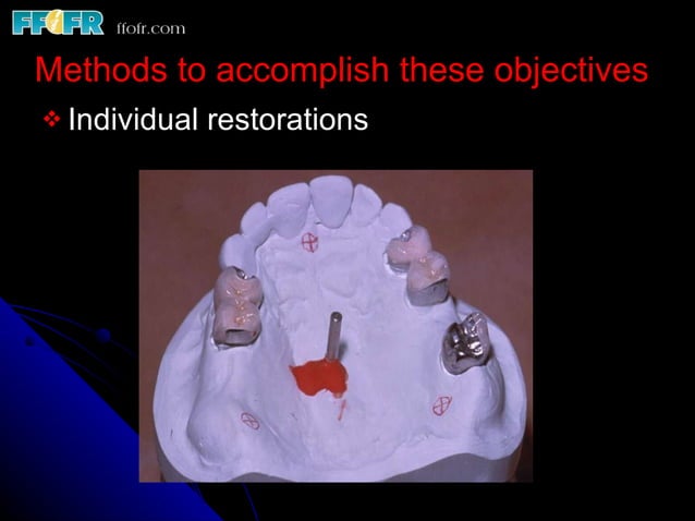 Introduction and basic components of rpd's copy | PPT | Dental Health ...