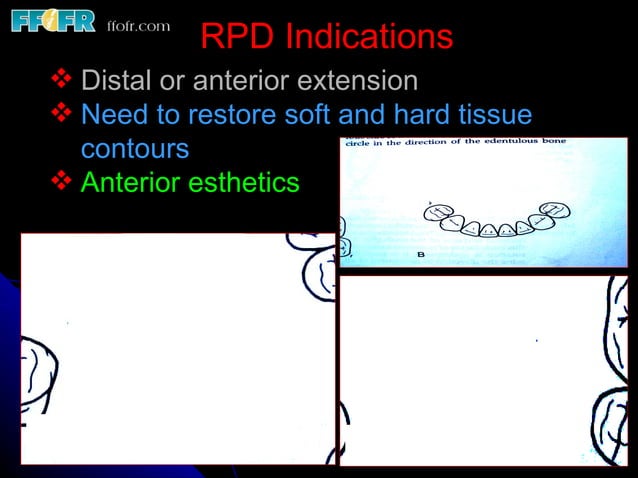 Introduction and basic components of rpd's copy | PPT | Dental Health ...
