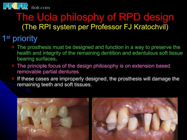 Introduction and basic components of rpd's copy | PPT | Dental Health ...