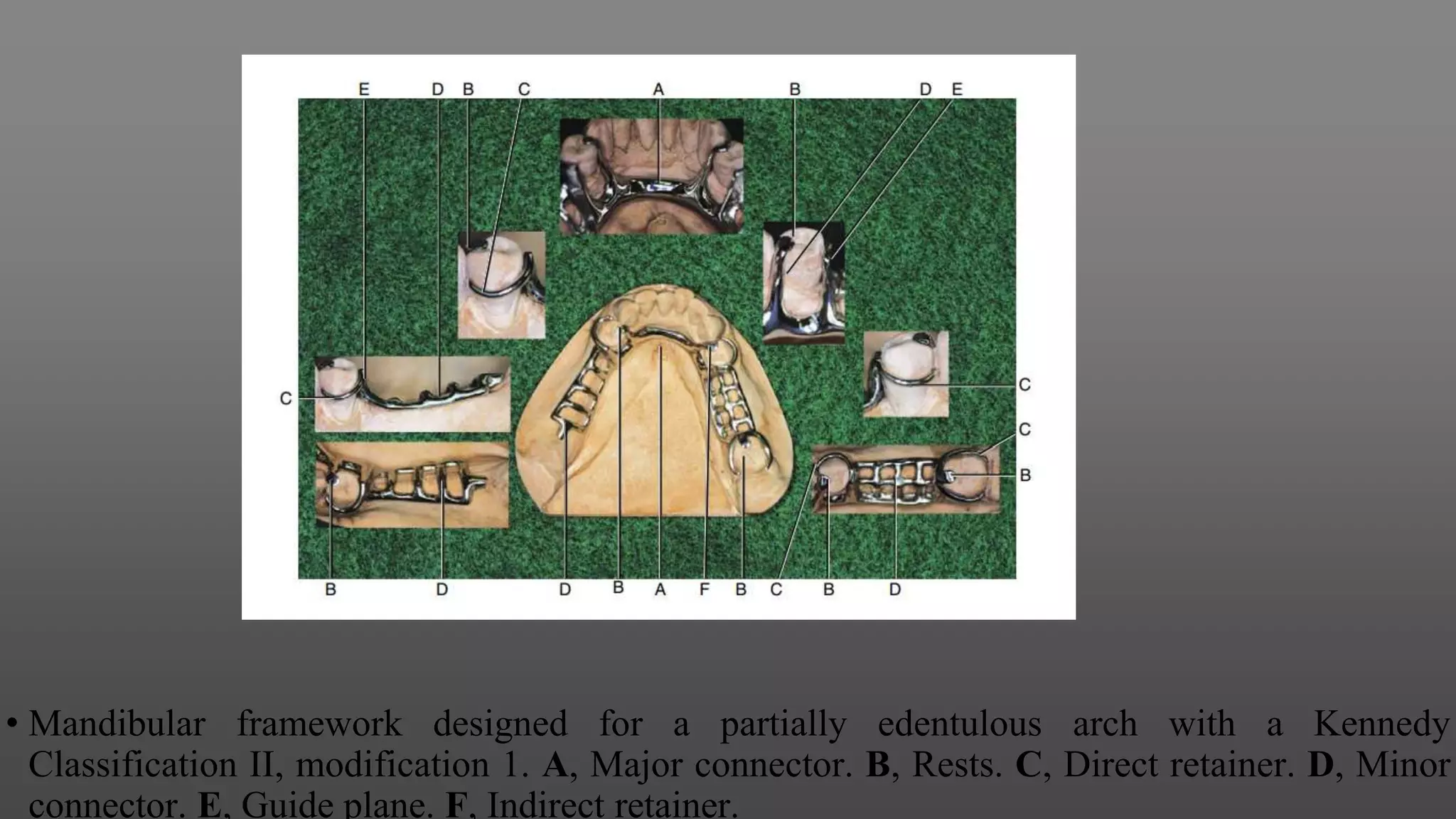 Introduction and Classification RPD | PPTX